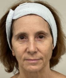 Firming Facial Skin – Medispa Physimed